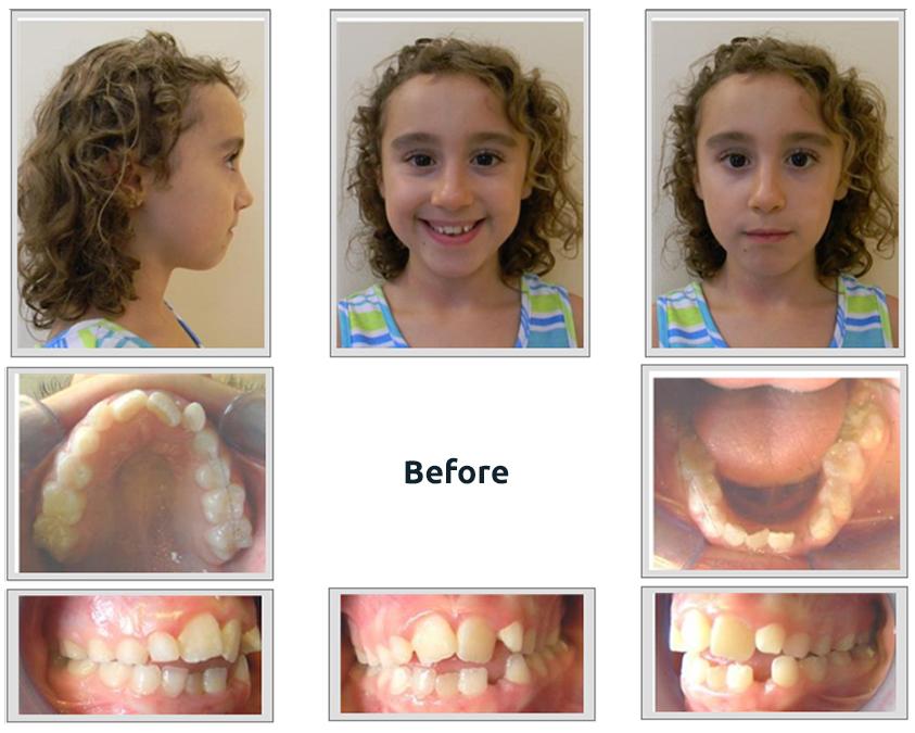 Adult and Child Teeth Straightening Results || Tina Reed Orthodontics