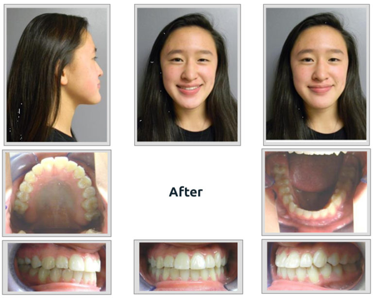 julia_after - Tina Reed Orthodontics