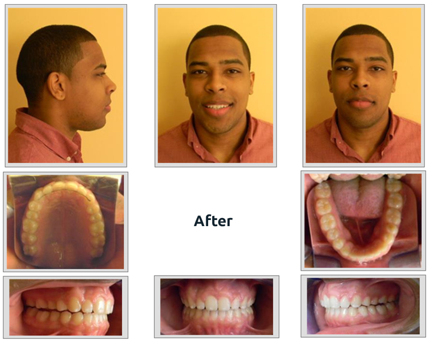 Adult and Child Teeth Straightening Results || Tina Reed Orthodontics