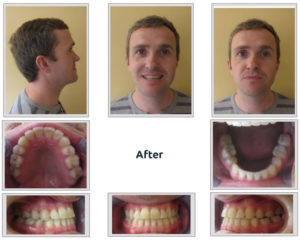 Adult and Child Teeth Straightening Results || Tina Reed Orthodontics