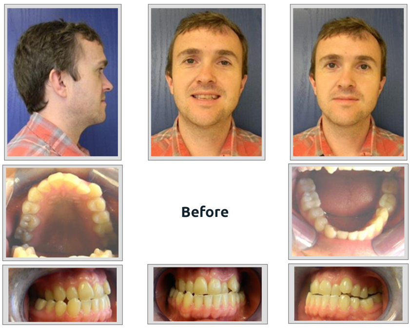 Adult and Child Teeth Straightening Results || Tina Reed Orthodontics