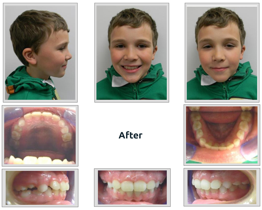 Adult and Child Teeth Straightening Results || Tina Reed Orthodontics
