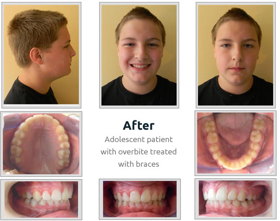 after-1 - Tina Reed Orthodontics
