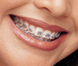 types_metal - Tina Reed Orthodontics
