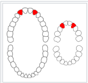 maxillary_laterals - Tina Reed Orthodontics